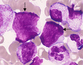 マントル細胞リンパ腫 - Mantle cell lymphoma - JapaneseClass.jp